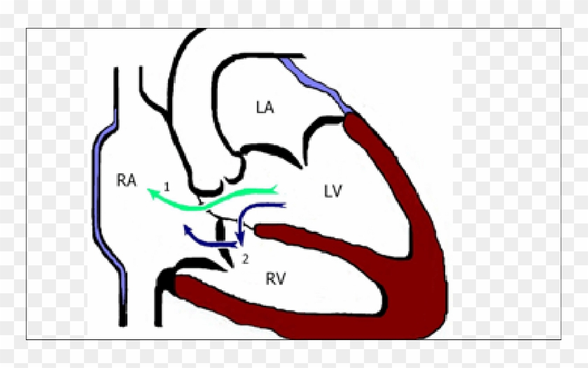Schematic Representation Of Gerbode Defect Types - Type 1 Gerbode ... Schematic Representation Of Gerbode Defect Types - Type 1 Gerbode ...
