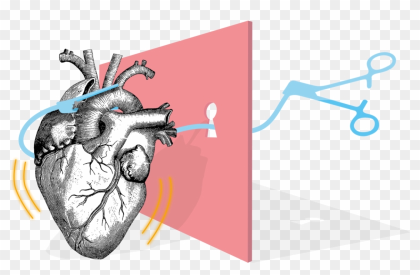 Surgery Drawing Open Heart - Minimally Invasive Cardiac Surgery Logo ...