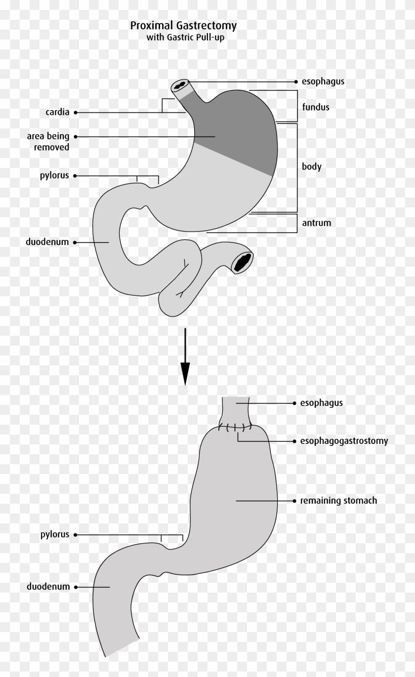 The Gastrointestinal Tract Is Then Reconstructed By - Proximal ...