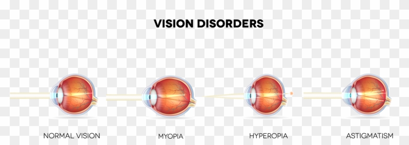 What Eye Conditions Does Lasik Treat - Normal Eye Vs Myopia, HD Png ...