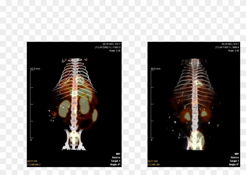 During Cardiac Stress Tests, Radioisotopes Used To - Rib, HD Png ...