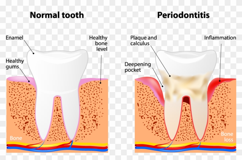 Dental Deep Cleaning - Scaling And Root Planing, HD Png Download ... Dental Deep Cleaning - Scaling And Root Planing, HD Png Download ...