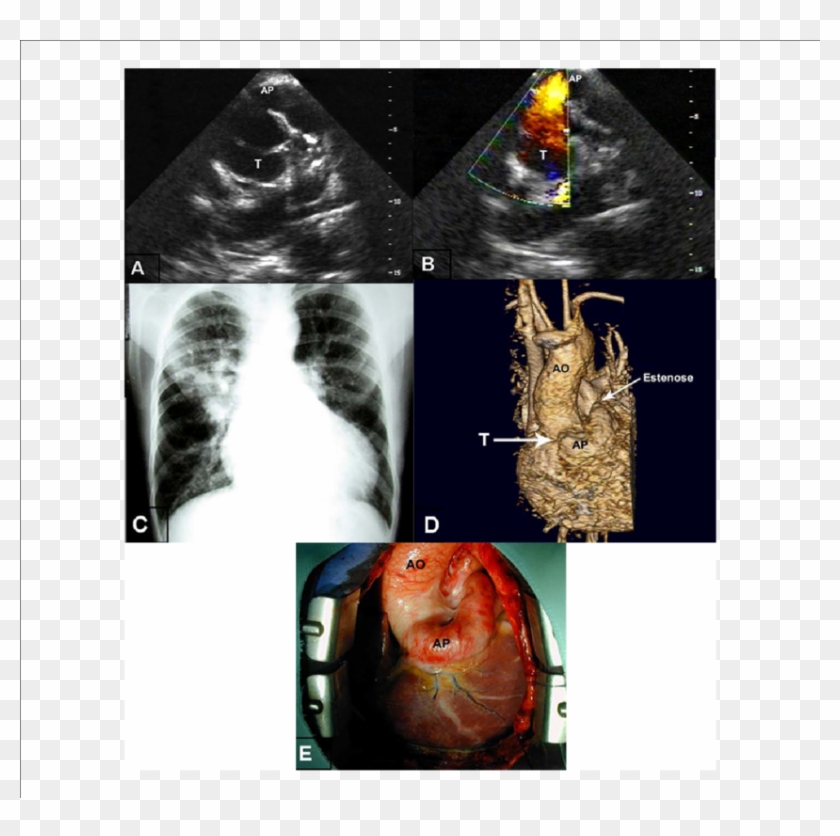 a) Ecocardiograma Demonstrando Art茅ria Pulmonar Emergindo - Radiology馃悕 ... a) Ecocardiograma Demonstrando Art茅ria Pulmonar Emergindo - Radiology馃悕 ...