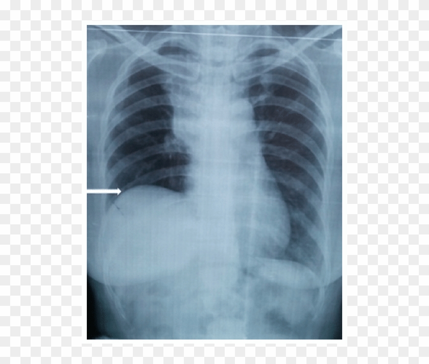 Chest X Ray Showing Elevated Right Hemi Diaphragm And - Elevated Right ...