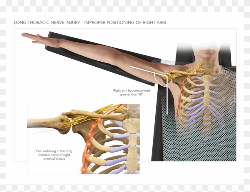 Long Thoracic Nerve Diagram