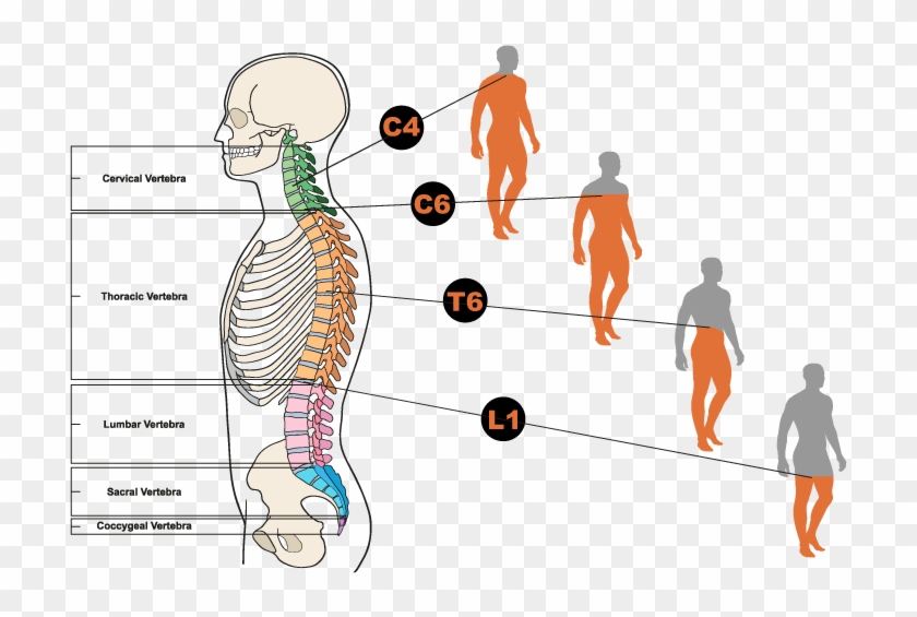Diagram Showing Different Types Of Spinal Cord Injuries - Illustration ... Diagram Showing Different Types Of Spinal Cord Injuries - Illustration ...